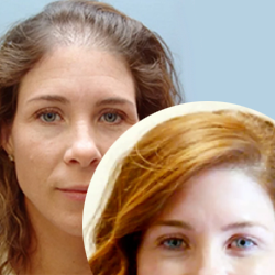 birmingham-mi-hair-transplants - Aurora Medi Spa & Plastic Surgery